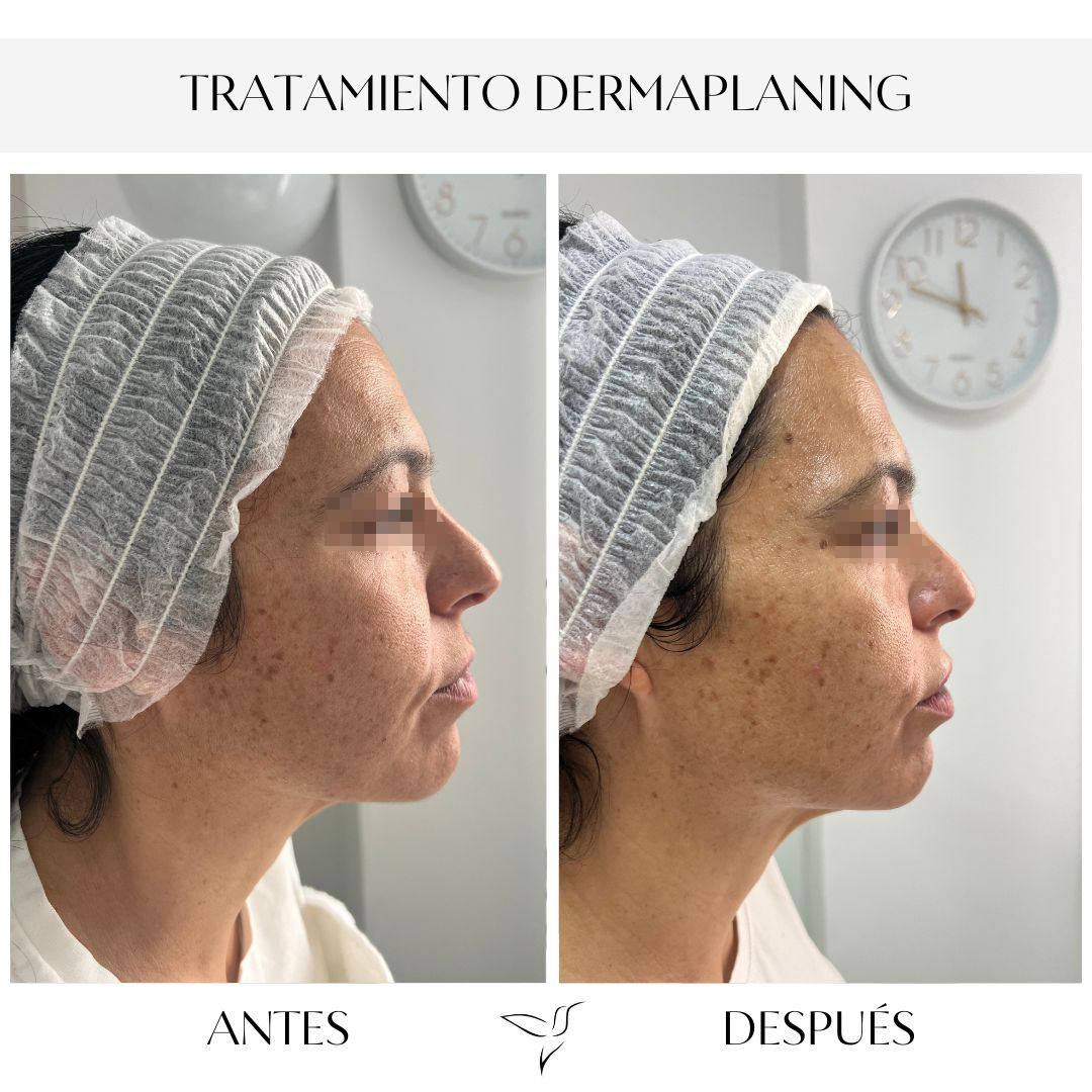 Dermaplaning - Clínica Dental y Medicina Estética Dr. Ruiz Vega